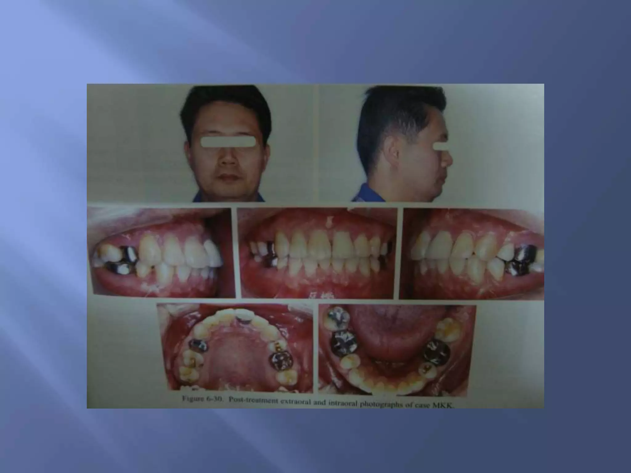 Clinical examples of microimplant anchorage | PPT