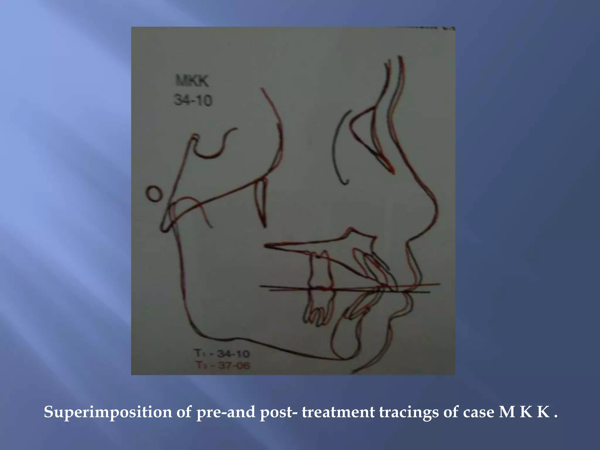 Clinical examples of microimplant anchorage | PPT