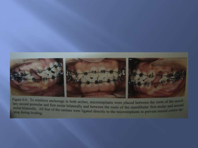 Clinical examples of microimplant anchorage | PPT