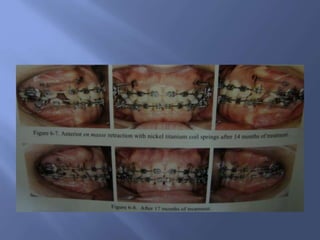 Clinical examples of microimplant anchorage | PPTX