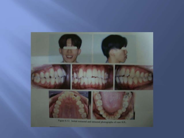 Clinical examples of microimplant anchorage | PPT