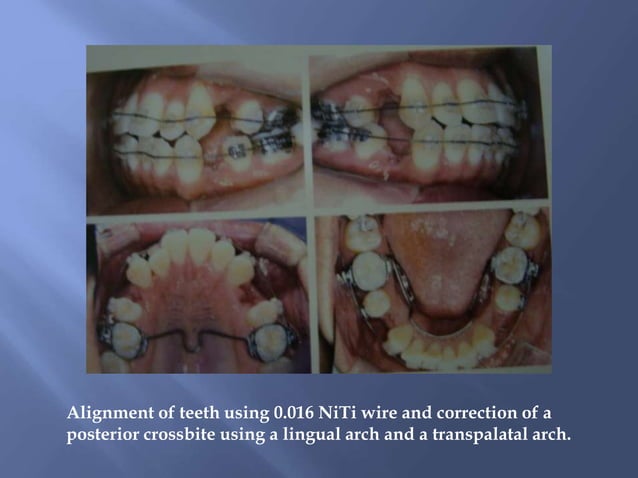Clinical examples of microimplant anchorage | PPT