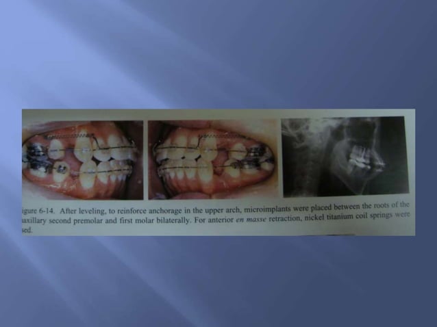 Clinical examples of microimplant anchorage | PPT