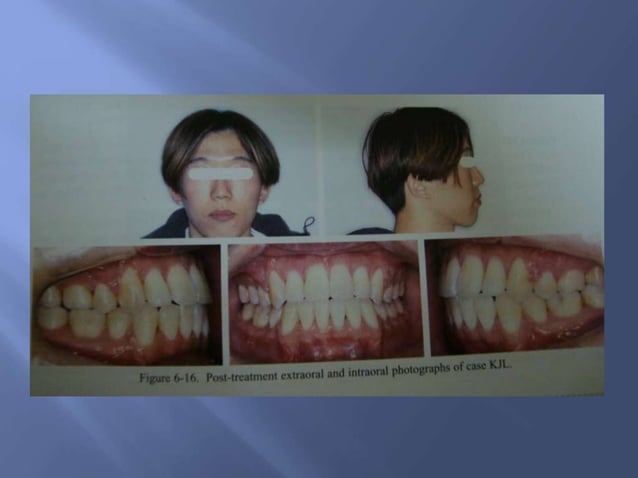 Clinical examples of microimplant anchorage | PPT