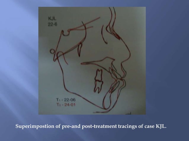 Clinical examples of microimplant anchorage | PPT