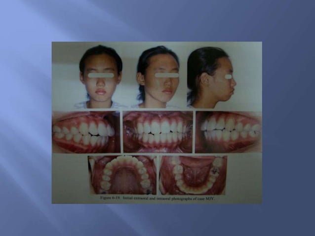 Clinical examples of microimplant anchorage | PPT