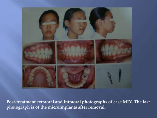 Clinical examples of microimplant anchorage | PPT