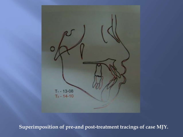 Clinical examples of microimplant anchorage | PPT