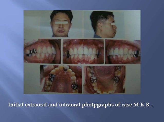 Clinical examples of microimplant anchorage | PPT