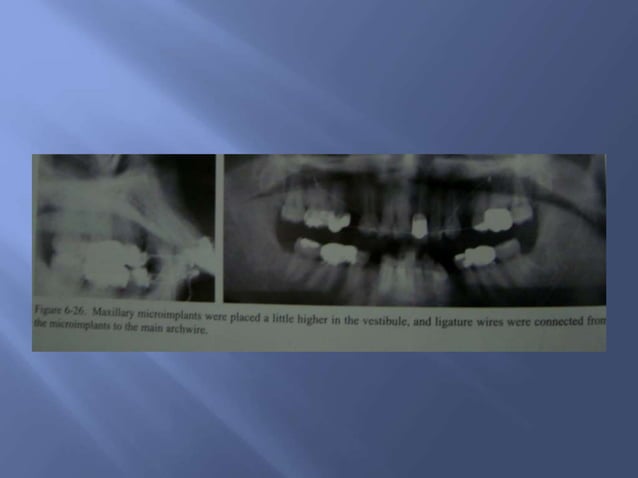 Clinical examples of microimplant anchorage | PPT