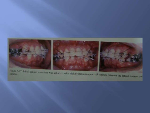 Clinical examples of microimplant anchorage | PPT