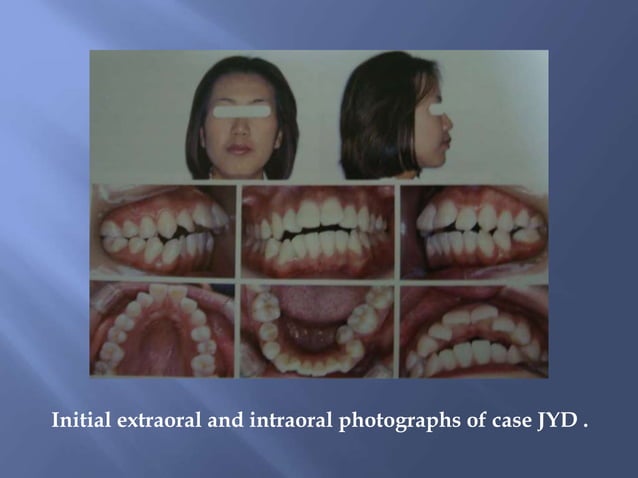 Clinical examples of microimplant anchorage | PPT