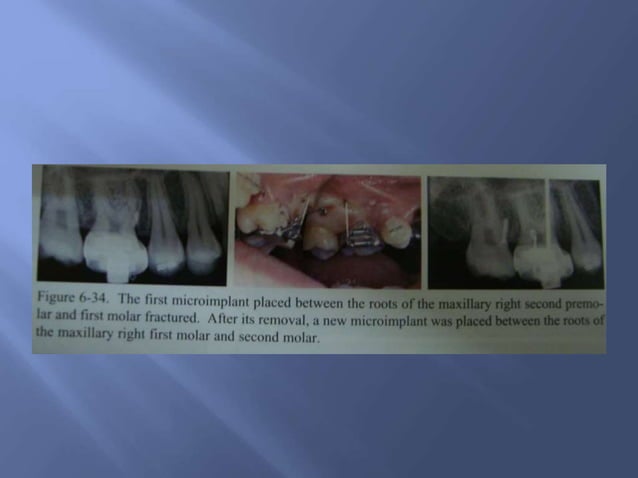 Clinical examples of microimplant anchorage | PPT