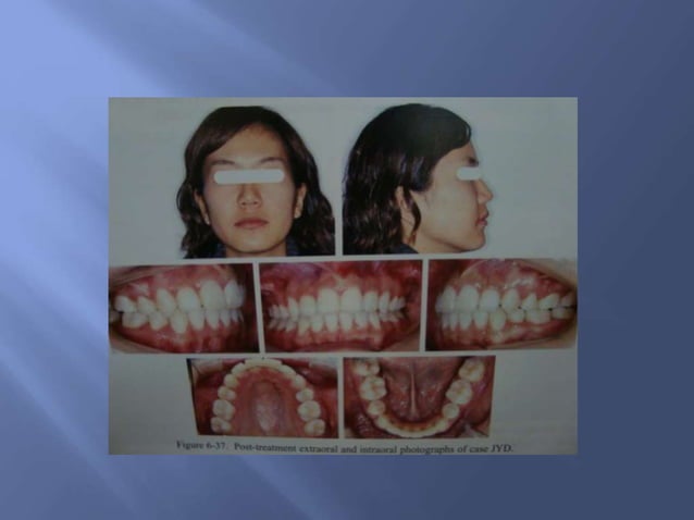 Clinical examples of microimplant anchorage | PPT