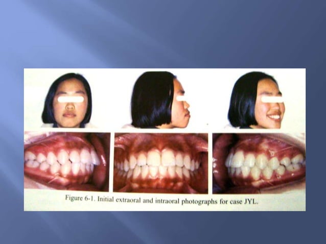 Clinical examples of microimplant anchorage | PPT