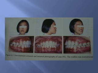 Clinical examples of microimplant anchorage | PPTX