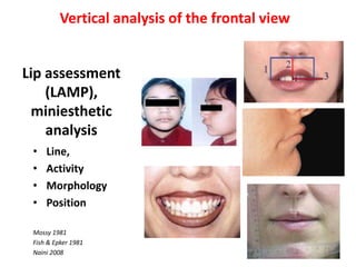 Clinical facial analysis (cfa) for orthodontists | PPTX