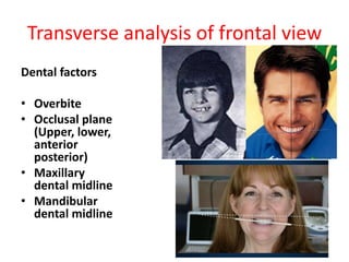Clinical facial analysis (cfa) for orthodontists | PPTX