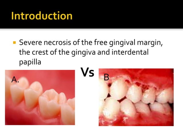 ANUG | PPTX | Dental Health | Diseases and Conditions
