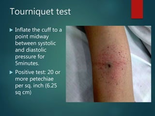 Clinical feature and diagnosis of japanese encephalitis and dengue (1 ...