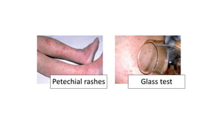 Clinical Features and Complications (1).pptx