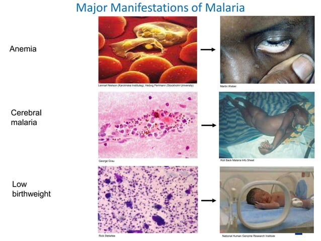 CLINICAL FEATURES AND COMPLICATIONS OF MALARIA | PPTX | Blood Disorders ...