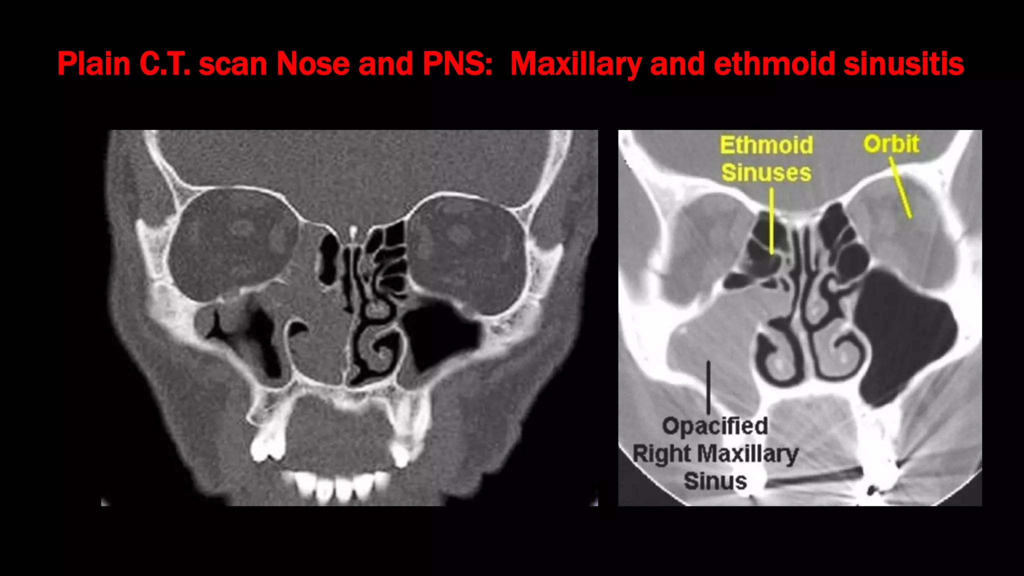 Clinical features and diagnosis of rhinosinusitis | PPT