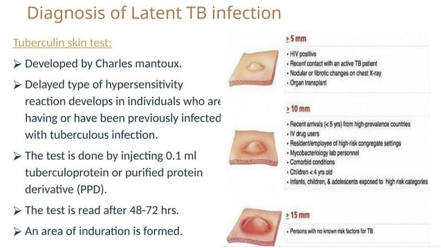 Clinical features and Diagnosis of TB.pptx | Free Download