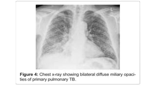 Clinical features and Diagnosis of TB.pptx | Free Download