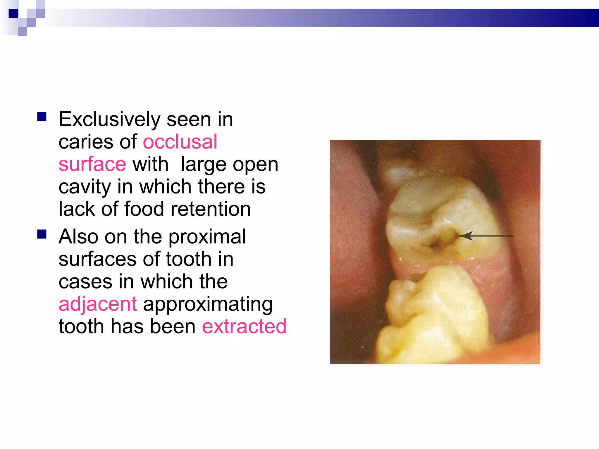 Clinical features and histopathology of dental caries | PPT