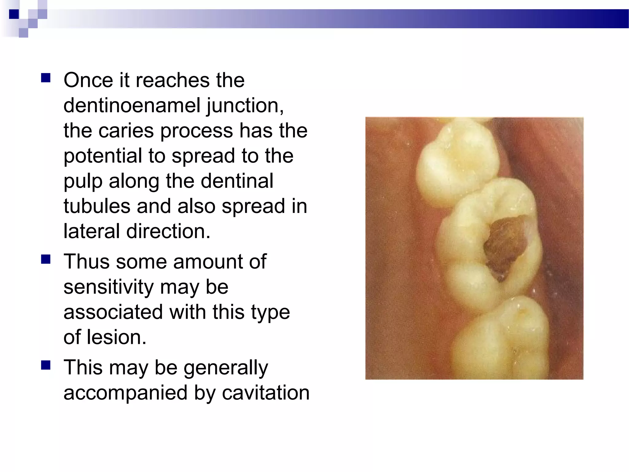Clinical features and histopathology of dental caries | PPT