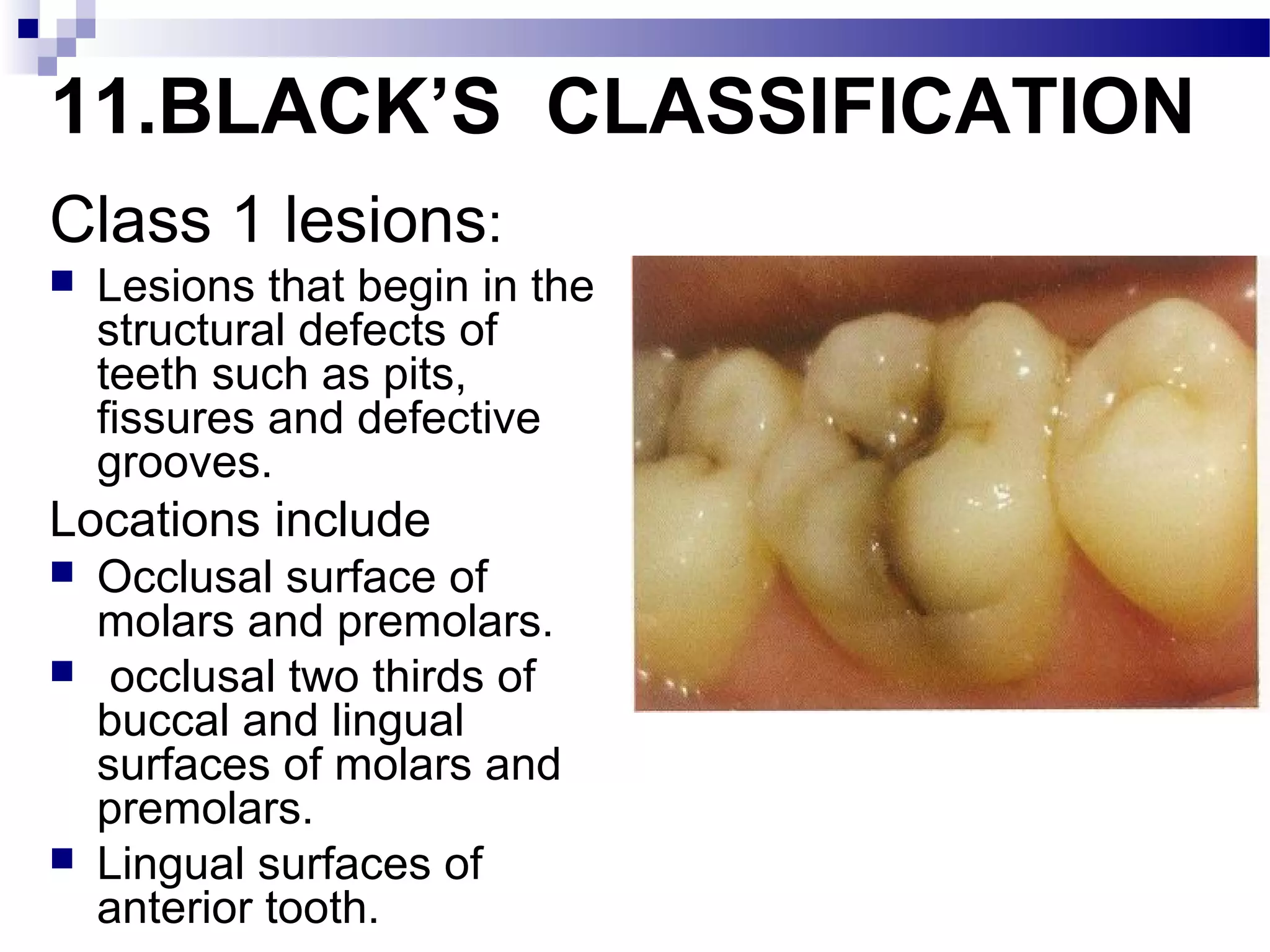 Clinical features and histopathology of dental caries | PPT