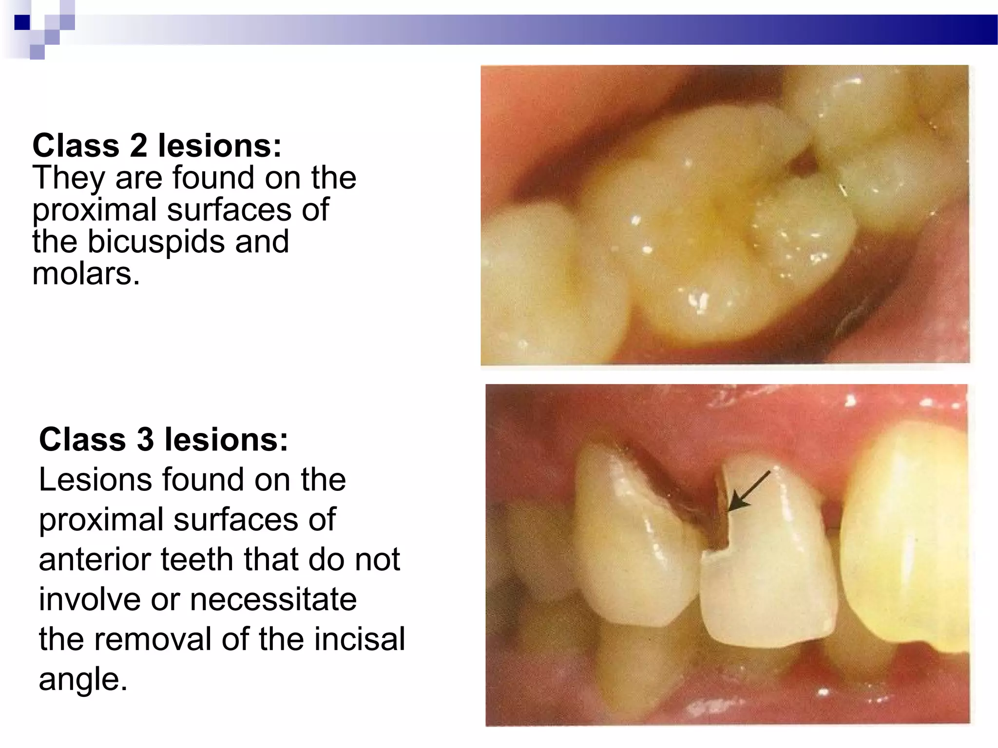 Clinical features and histopathology of dental caries | PPT