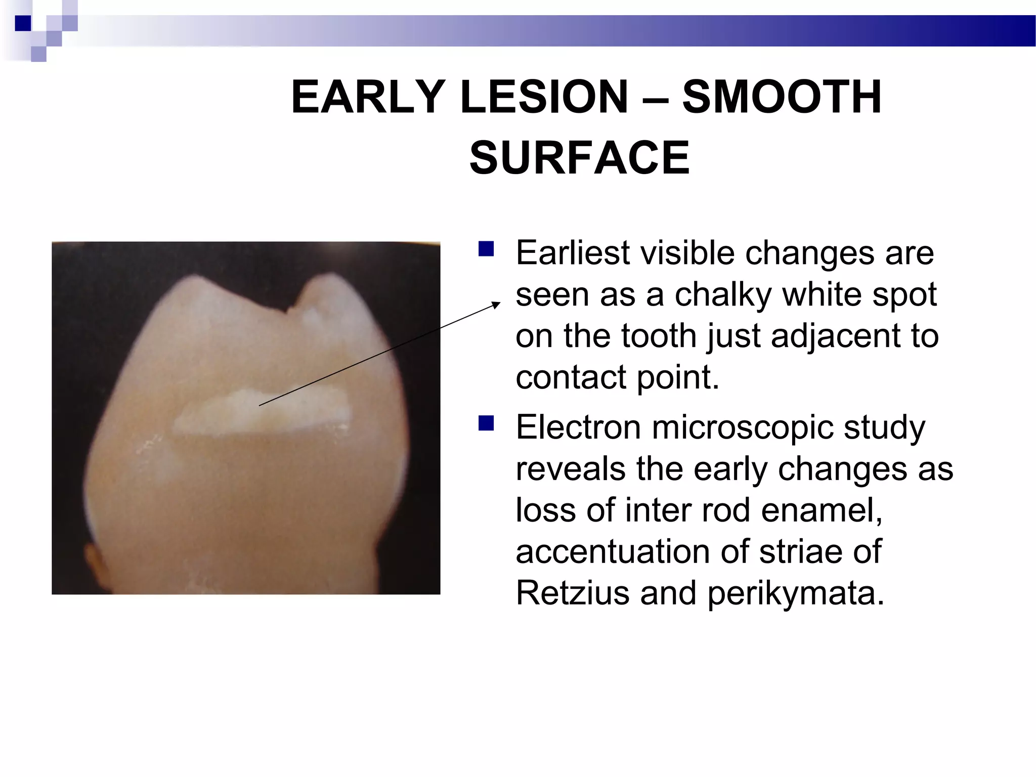 Clinical features and histopathology of dental caries | PPT