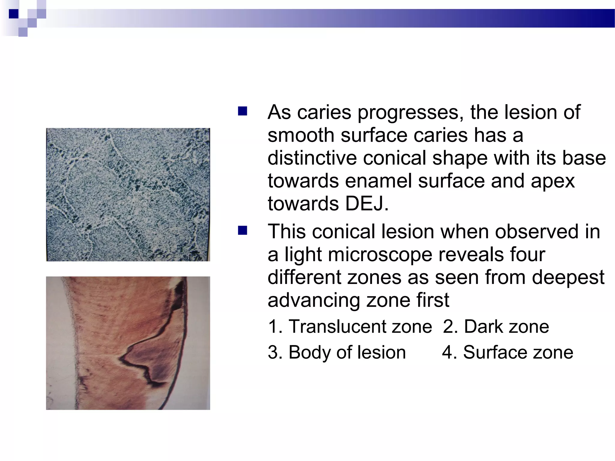Clinical features and histopathology of dental caries | PPT
