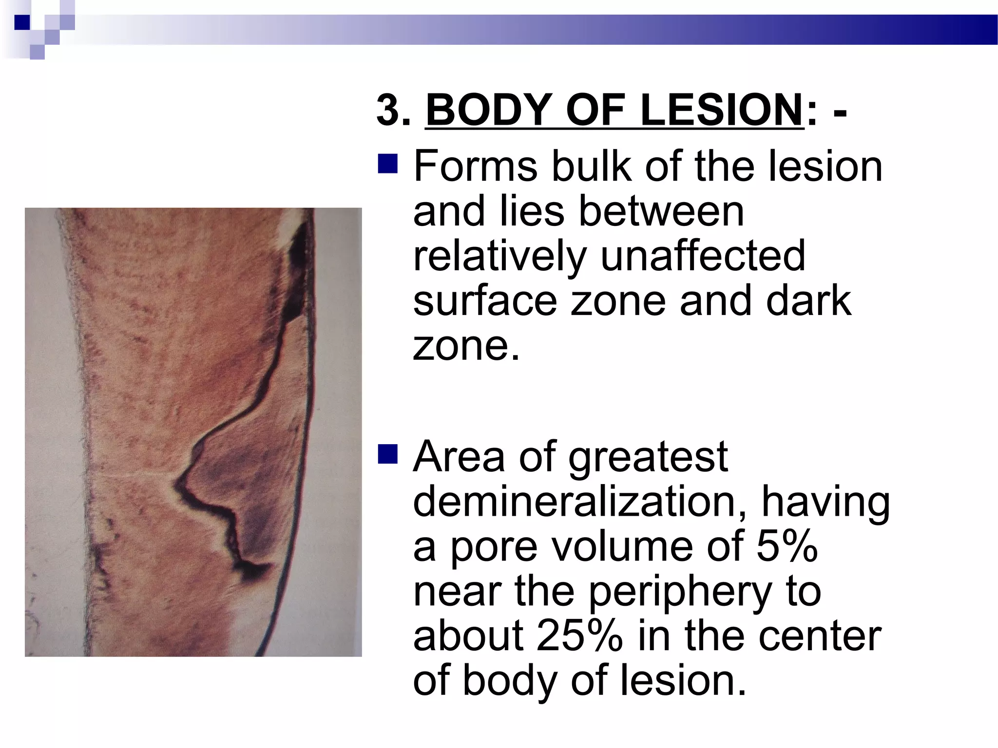Clinical features and histopathology of dental caries | PPT