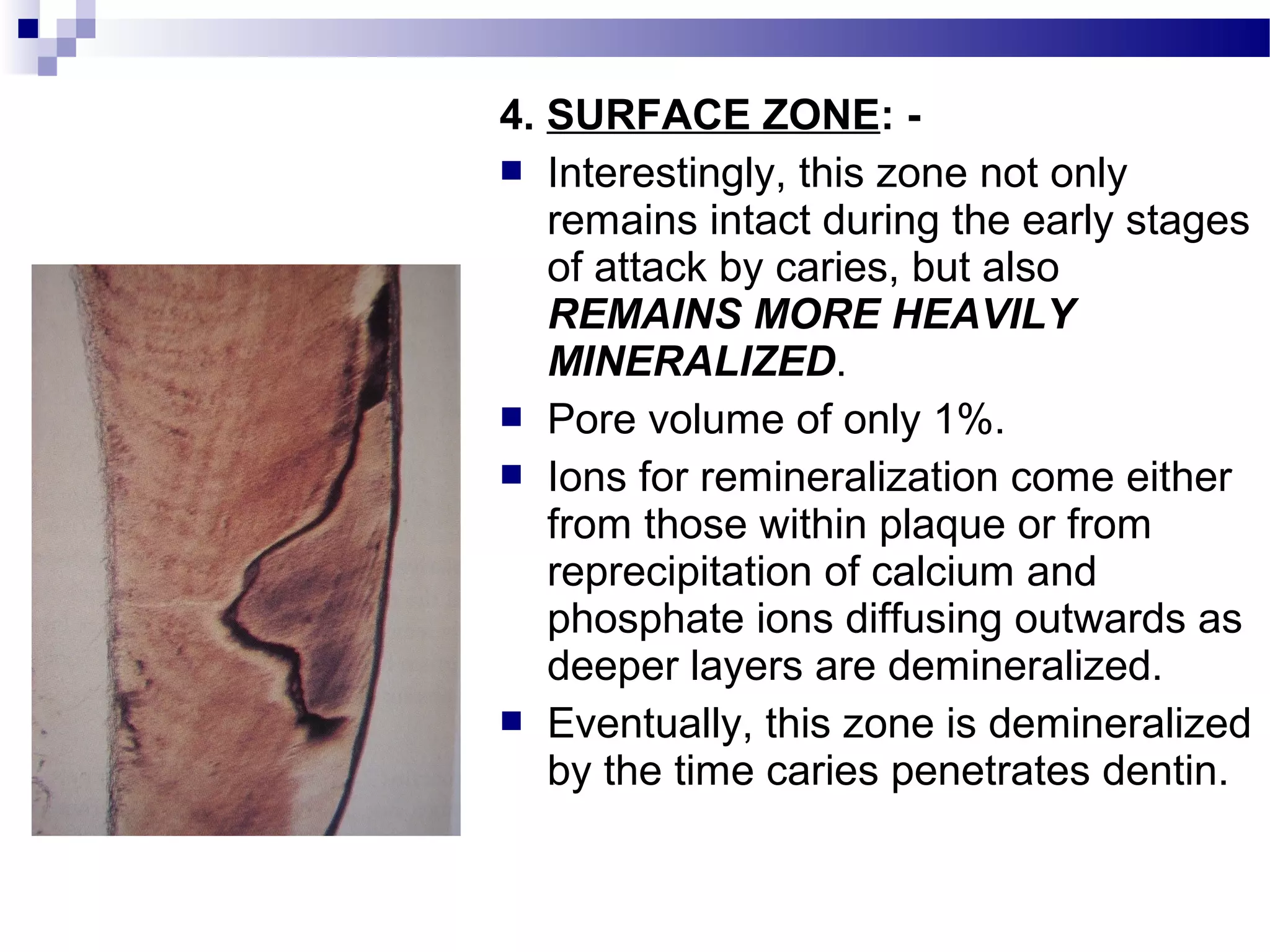 Clinical features and histopathology of dental caries | PPT