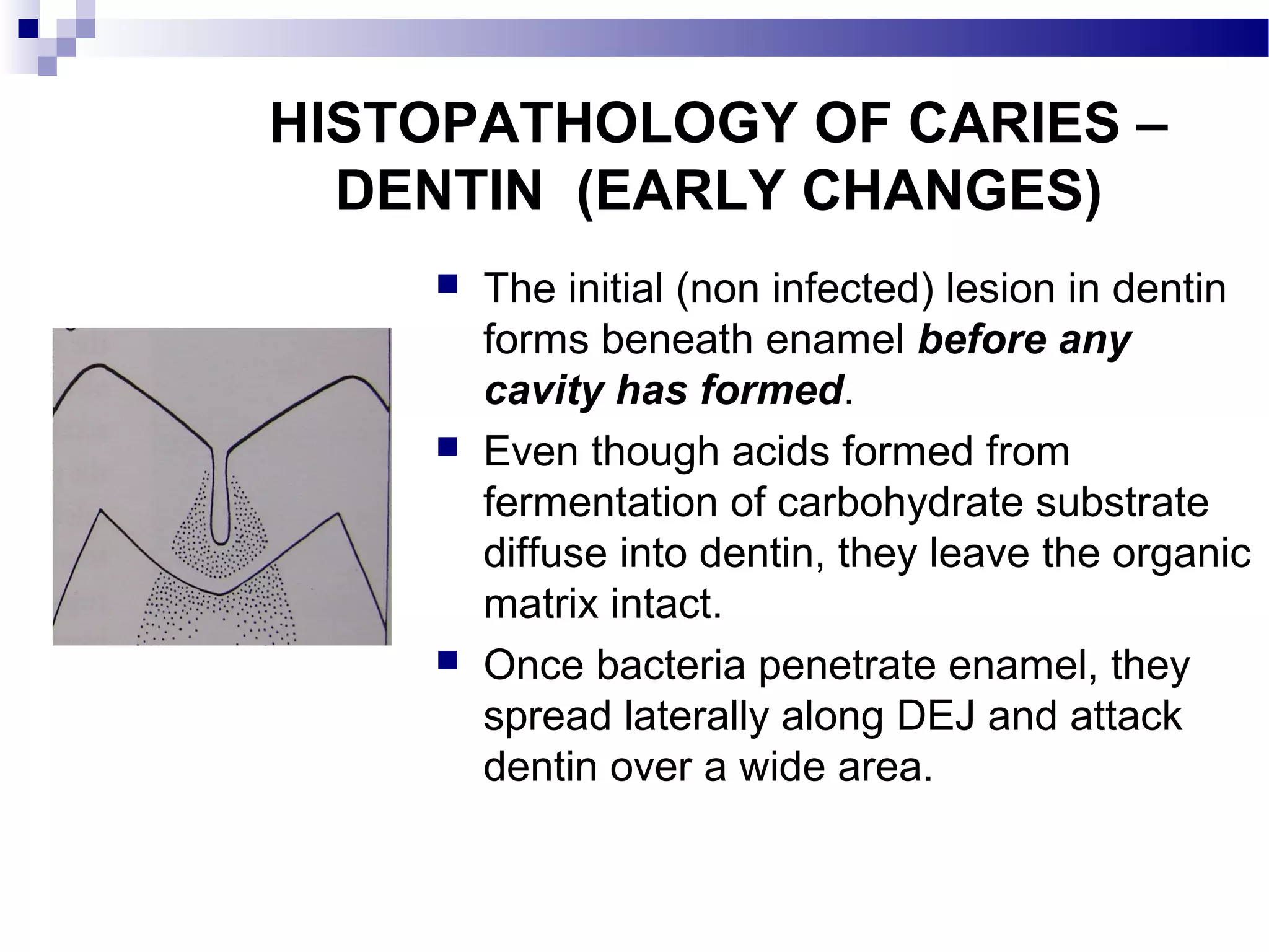Clinical features and histopathology of dental caries | PPT