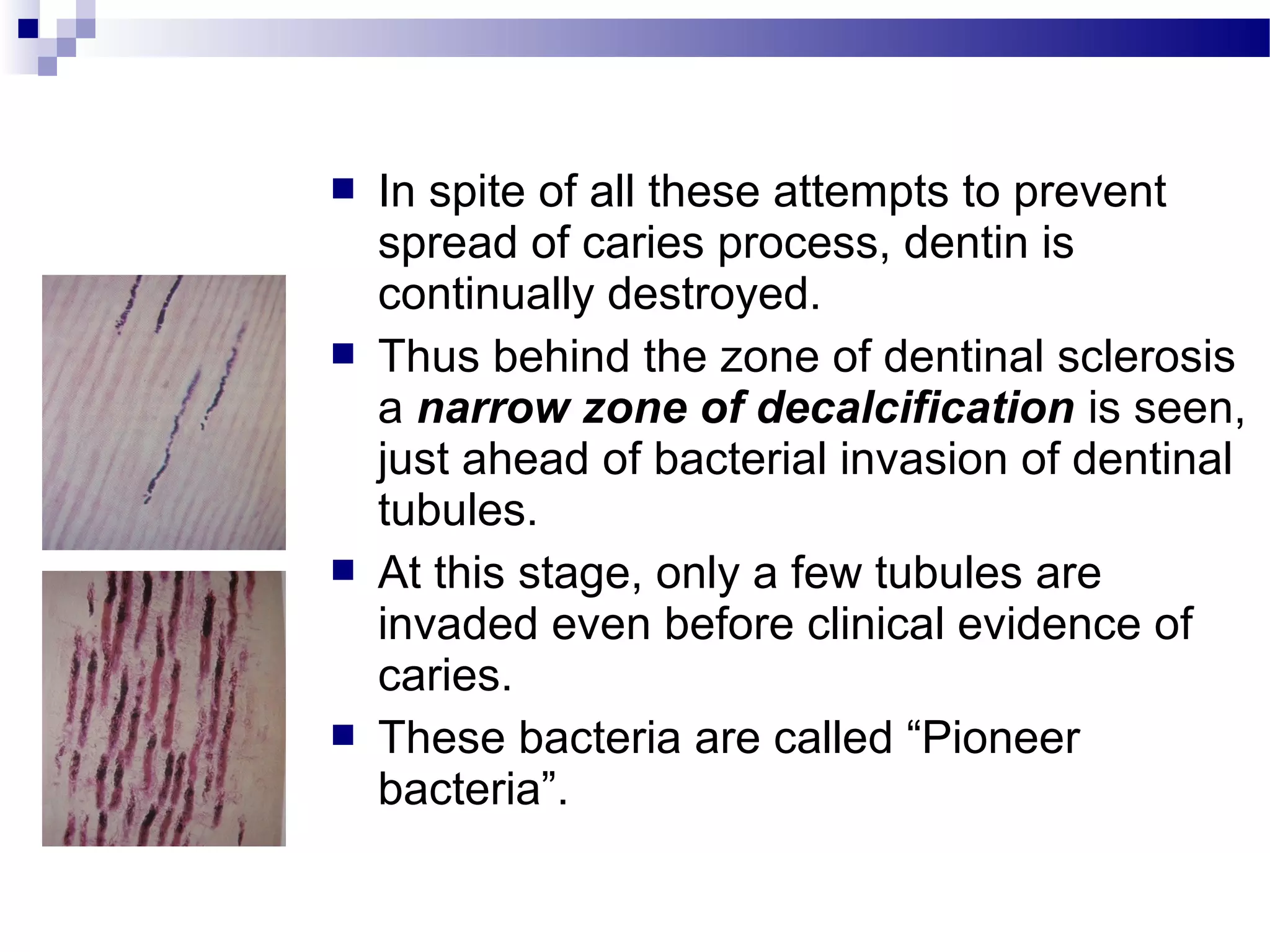 Clinical features and histopathology of dental caries | PPT