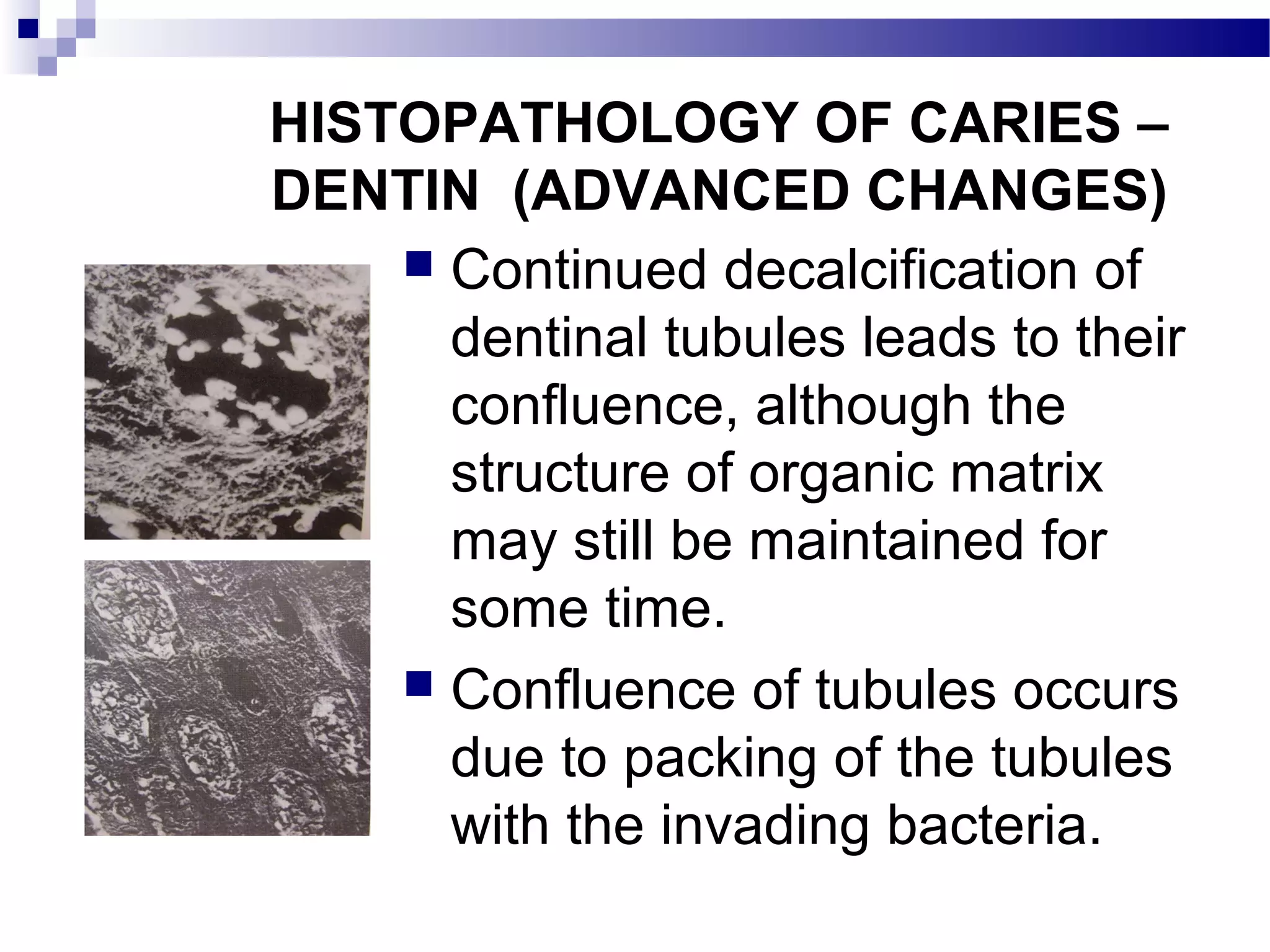 Clinical features and histopathology of dental caries | PPT