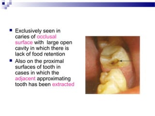 Clinical features and histopathology of dental caries | PPT