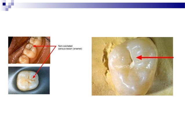 Clinical features and histopathology of dental caries | PPT | Dental ...