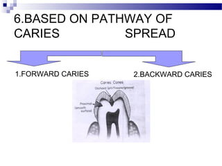 Clinical features and histopathology of dental caries | PPT