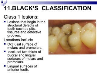 Clinical features and histopathology of dental caries | PPT