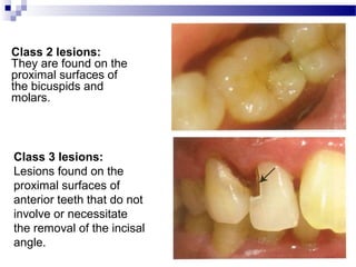 Clinical features and histopathology of dental caries | PPT