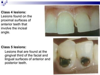 Clinical features and histopathology of dental caries | PPT