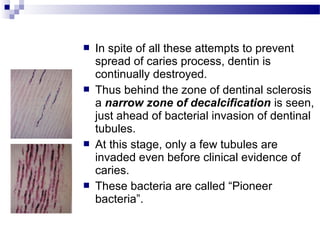 Clinical features and histopathology of dental caries | PPT