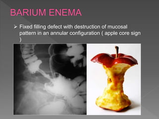 Clinical features and investigation of carcinoma colon | PPTX