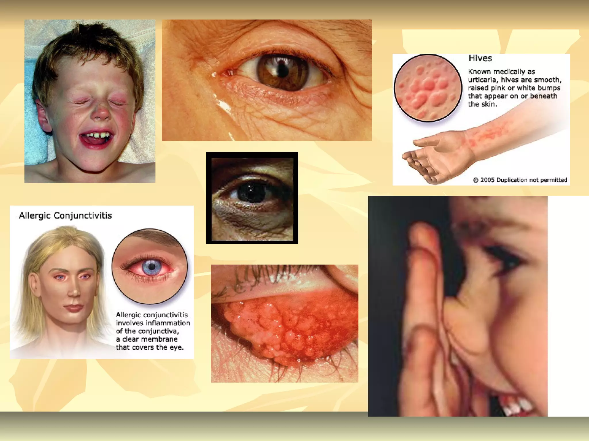 Clinical features and investigations of allergic rhinitis | PPT