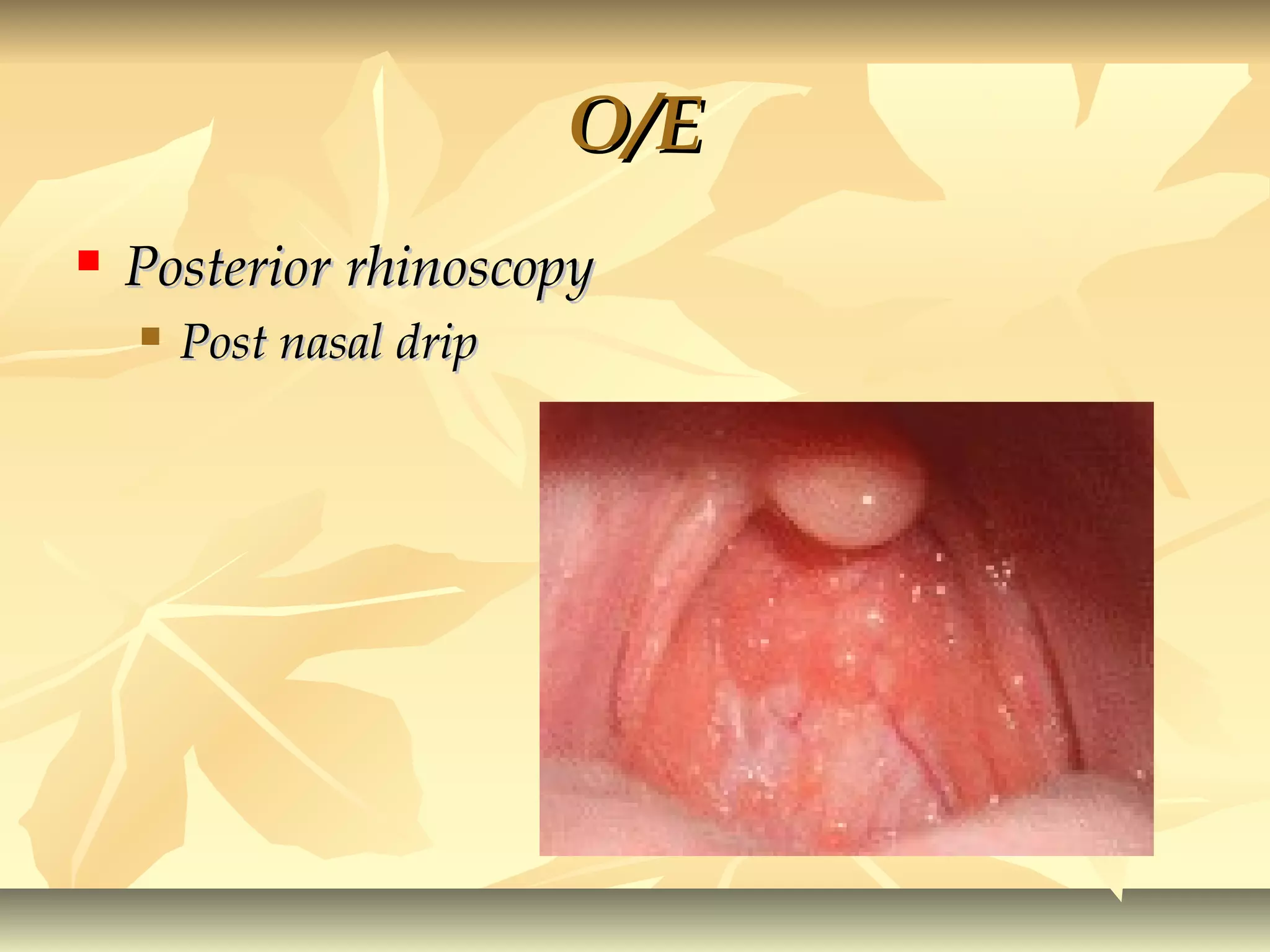 Clinical features and investigations of allergic rhinitis | PPT